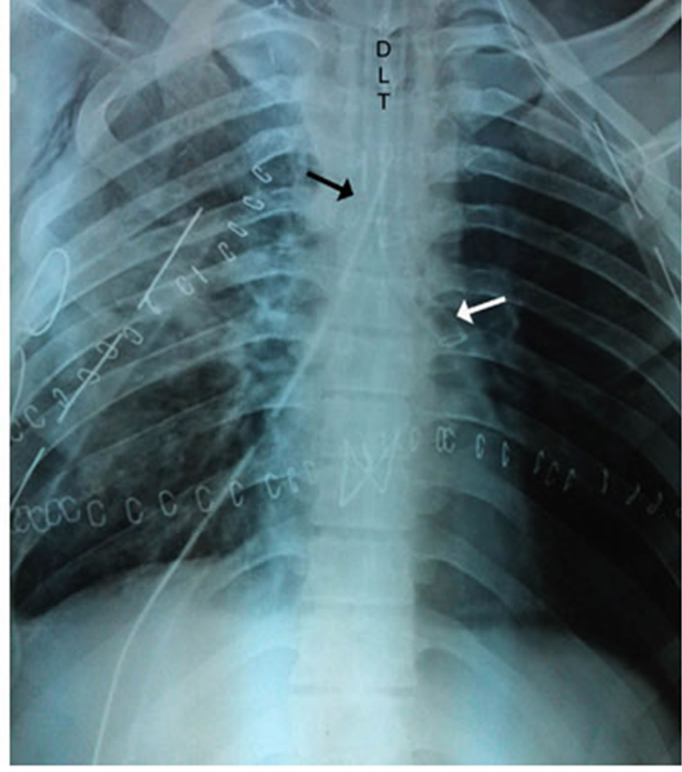 Independent Lung Ventilation for Reexpansion Pulmonary Edema*