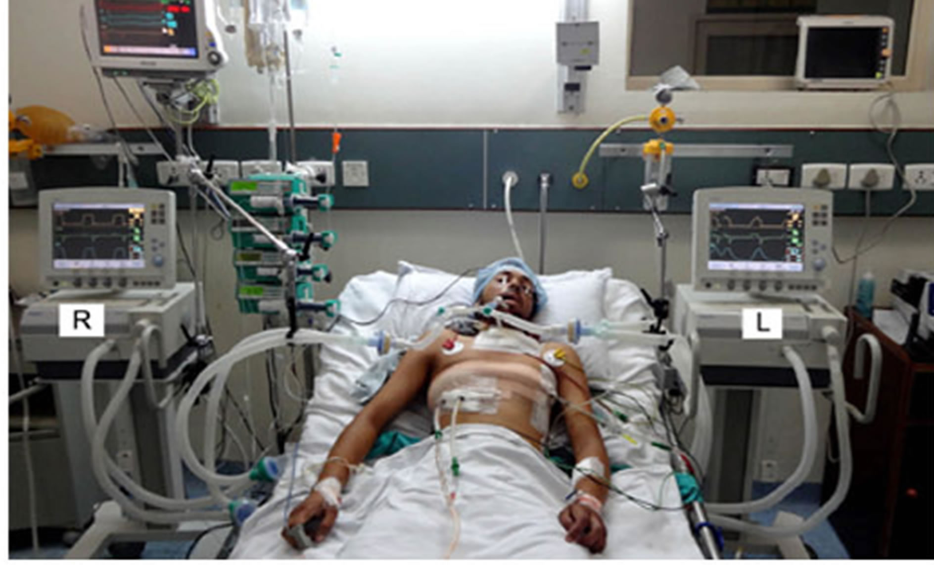 Independent Lung Ventilation For Reexpansion Pulmonary Edema 
