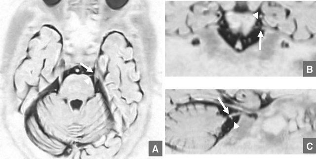 Significance and utility of MR cisternography for diagnosis and ...