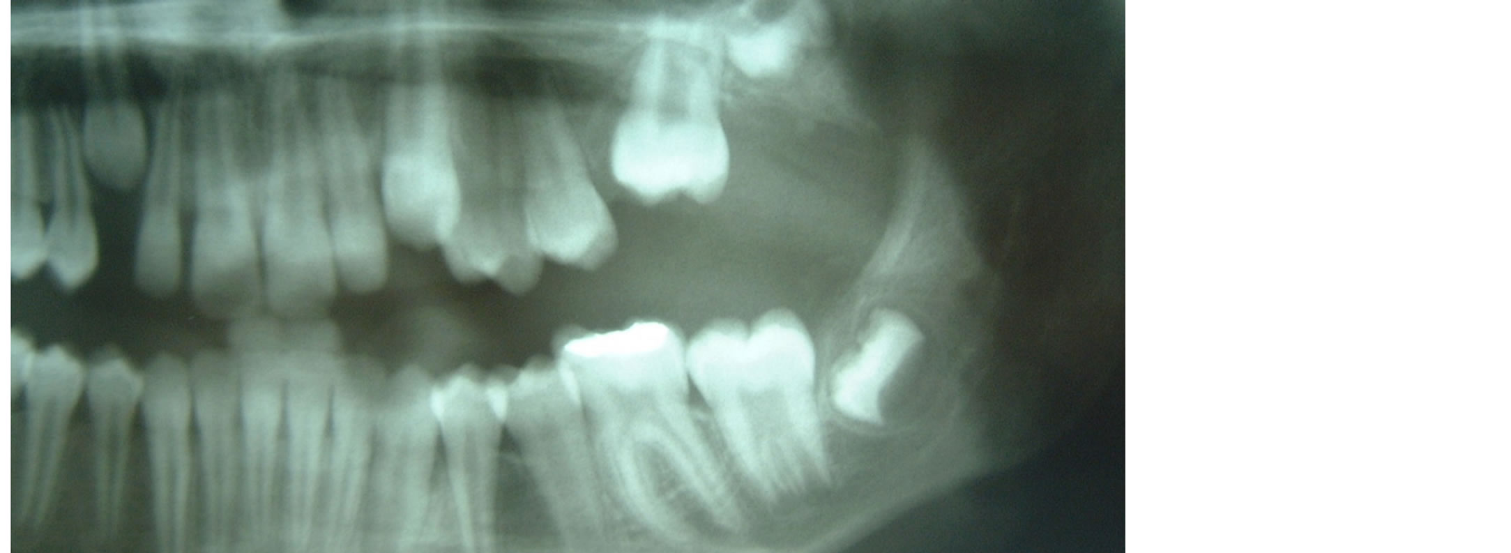 Extraction Timing of Heavily Destructed Upper First Permanent Molars