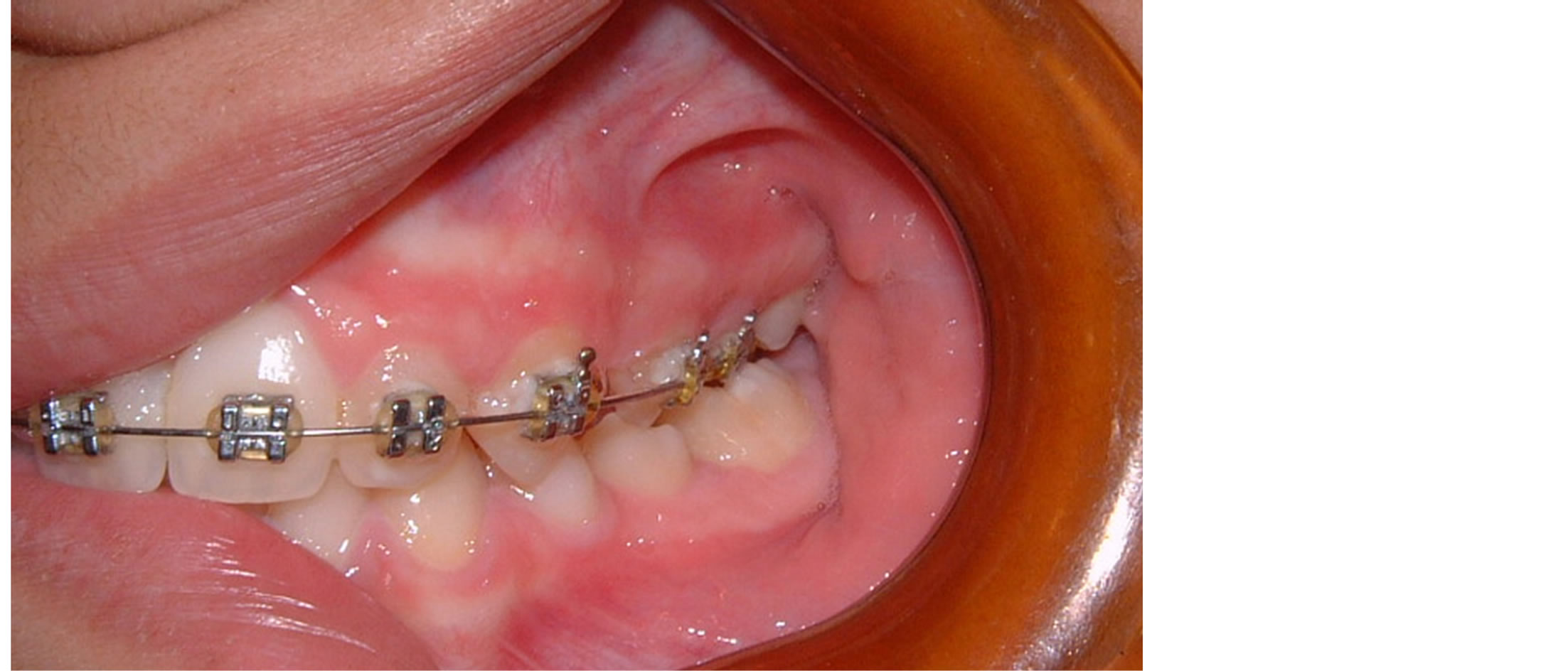 Extraction Timing of Heavily Destructed Upper First Permanent Molars