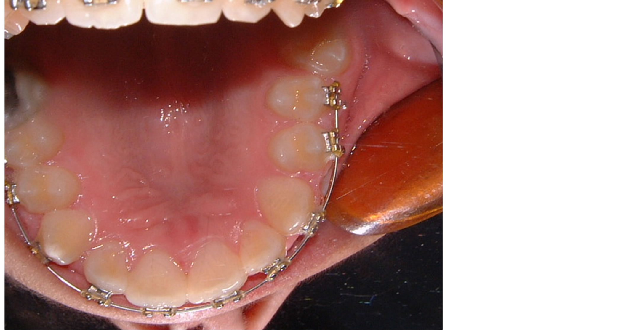Extraction Timing of Heavily Destructed Upper First Permanent Molars