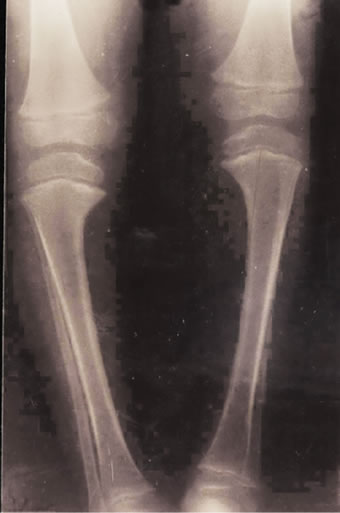 Minimal Invasive Technique for Correction of Bowlegs in Children