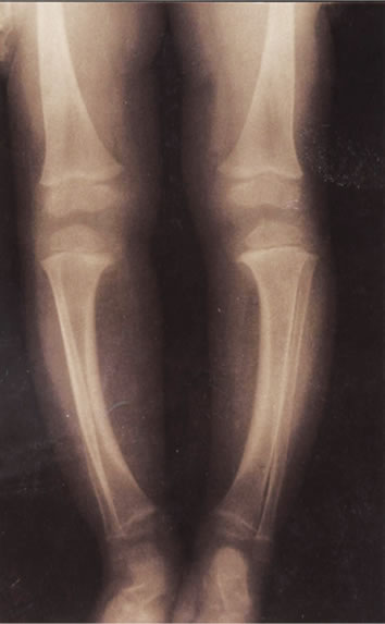 Minimal Invasive Technique for Correction of Bowlegs in Children