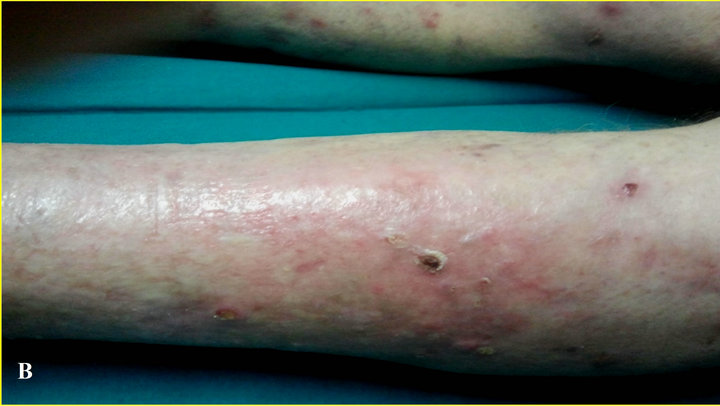 Effects of a New Human Recombinant MnSOD in the Treatment of Photoaging ...