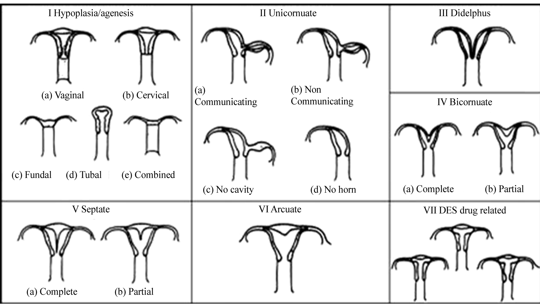 Case Series Of Mullerian Developmental Defects Encountered In A