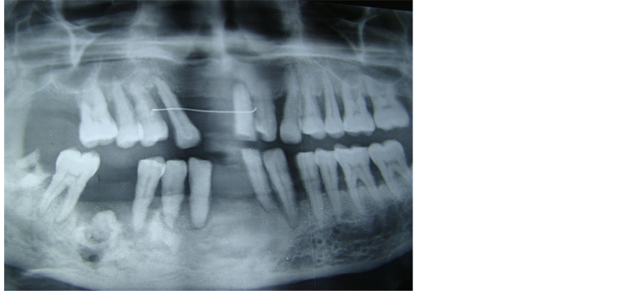 Intra Oral Approach for Complex & Compound Odontomas (Large or Small)