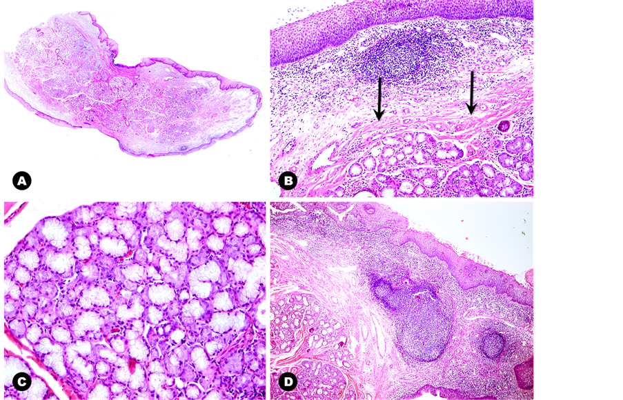 Hamartomatous Polyp of Minor Salivary Gland Arising in the Tongue: A ...