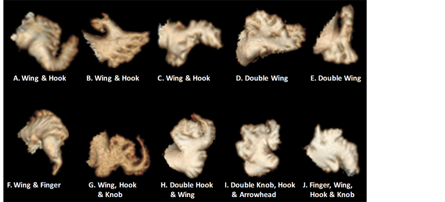 The Morphology of Left Atrial Appendage Lobes: A Novel Characteristic ...