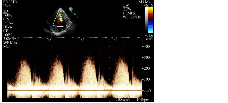 Penetrating Trauma Resulting in Ventricular Septal Defect
