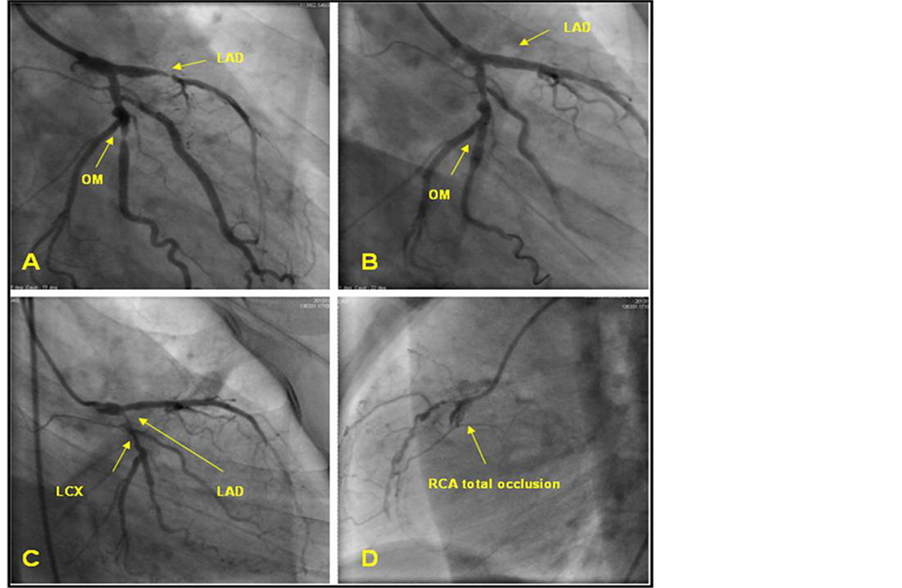 Accelerated Atherosclerosis in a Young Female with Familial ...