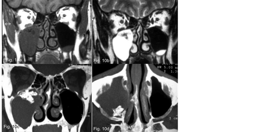 Silent Sinus Syndrome: Clinical Findings and Differential Diagnosis