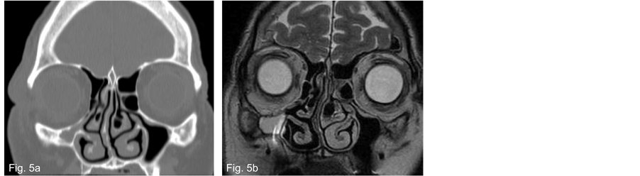 Silent Sinus Syndrome: Clinical Findings and Differential Diagnosis