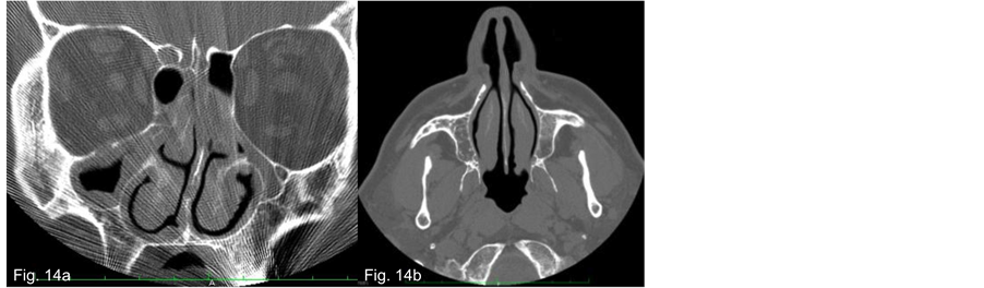 Silent Sinus Syndrome: Clinical Findings and Differential Diagnosis