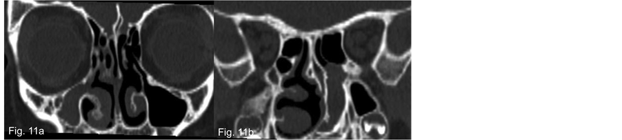 Silent Sinus Syndrome: Clinical Findings and Differential Diagnosis