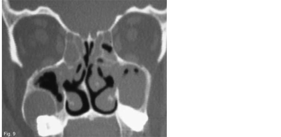 Silent Sinus Syndrome: Clinical Findings and Differential Diagnosis