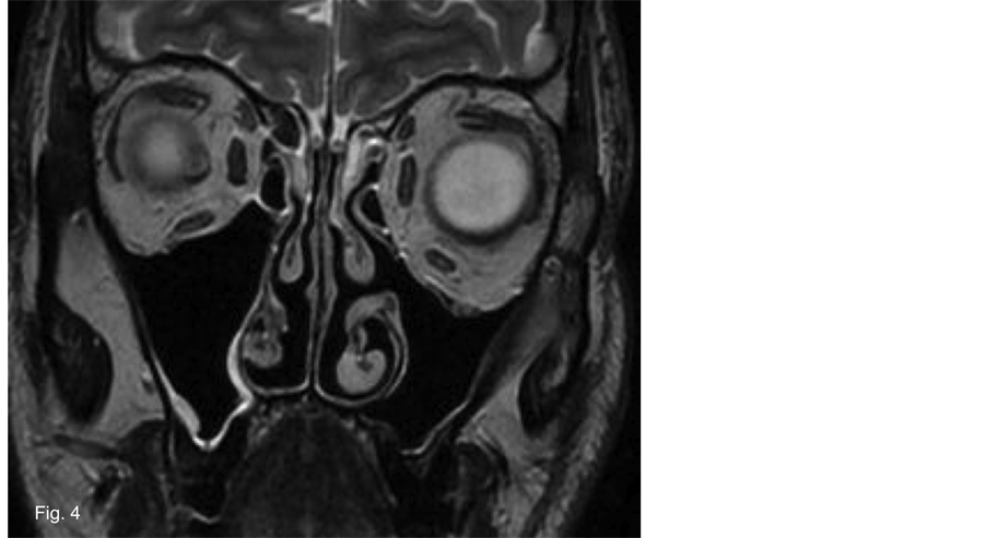 Silent Sinus Syndrome: Clinical Findings and Differential Diagnosis