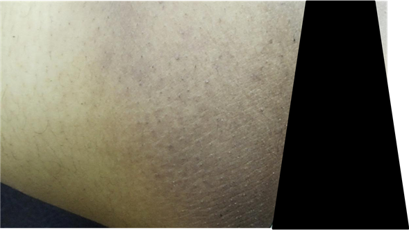 Frictional Melanosis of Rubbing Thighs in Iraqi Patients
