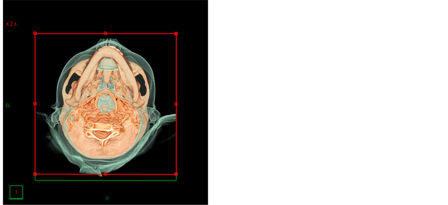 Clinical Photograph: “A Third Arythenoid?”