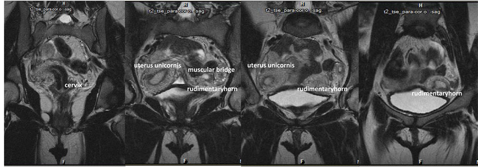 Diagnostic and Laparoscopic Management of Unicornuate Uterus with ...