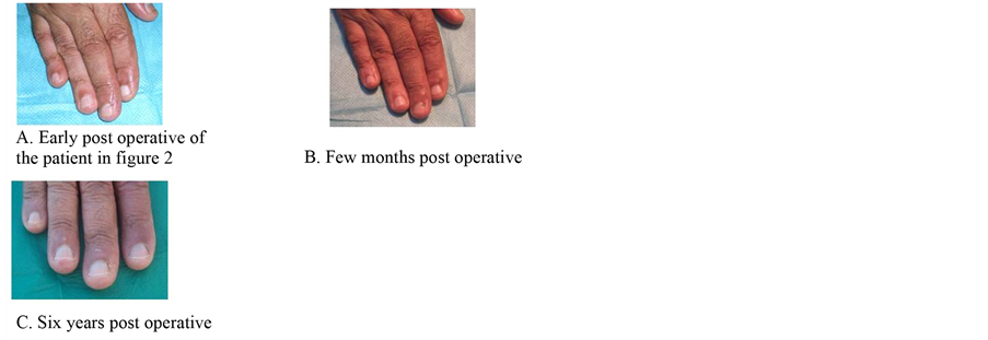 Ingrowing Nail Correction by Advancing Composite Flap of the Nailbed ...