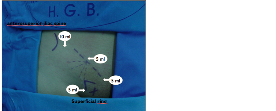 Inguinal Hernia Repair with Local Anesthesia in the Outpatient—10 Year ...