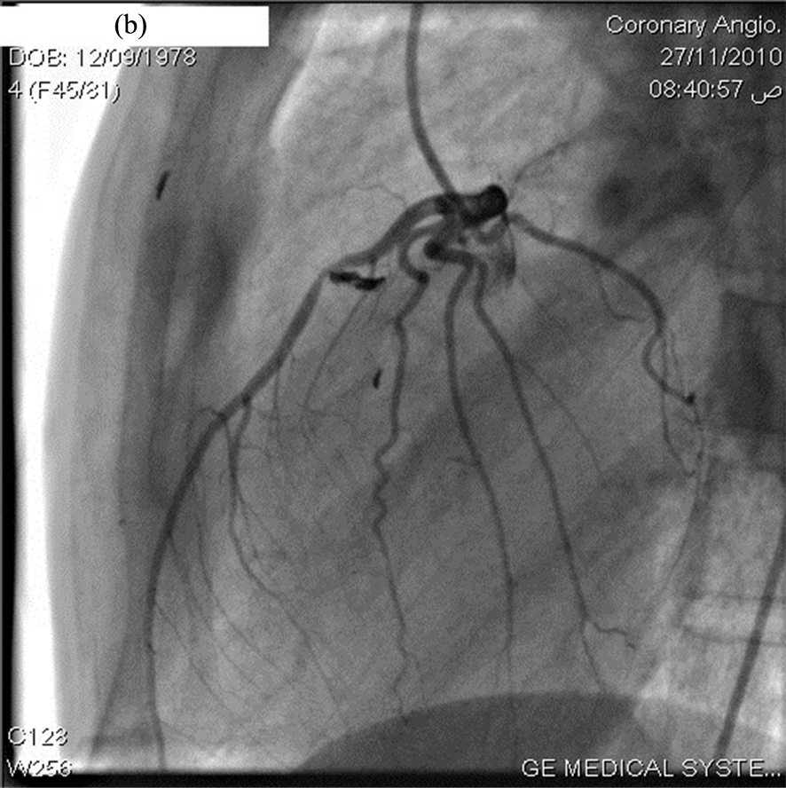 Myocardial Ischemia Following Shrapnel Epicardiac Injury 16 Years ...