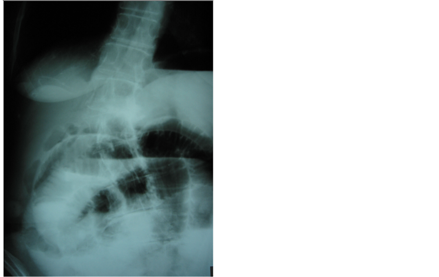 Gallstone Ileus: A Case Report and Our Clinic’s Experience