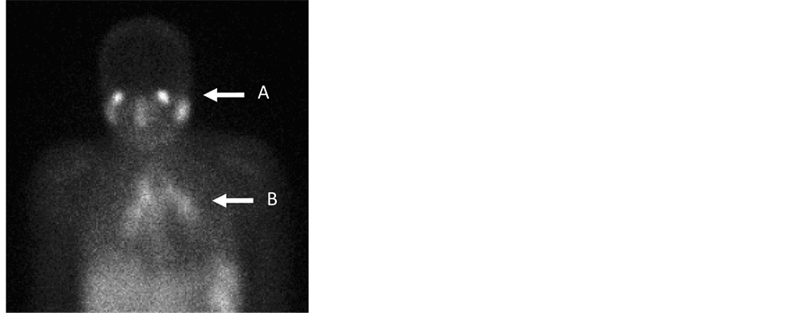 Diagnosis And Corresponding Gallium Scan