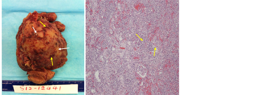 Emphysematous Pyelonephritis in a Renal Transplant Patient
