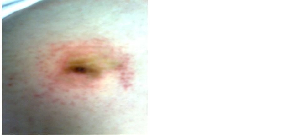 Diagnostic Evaluation of Ehrlichia canis Human Infections