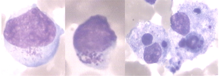 γδ-T Large Granular Lymphocyte Leukemia Associated Hemaphagocytic ...