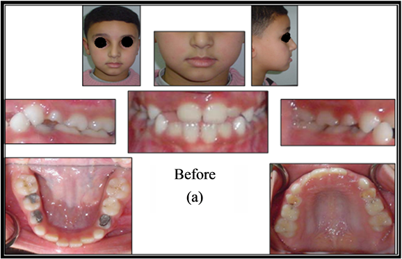 Orthopedic Correction of Class III Malocclusions during Mixed Dentition