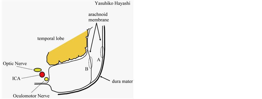Hematoma within the Outer Membrane of the Arachnoid Cyst Located in the ...
