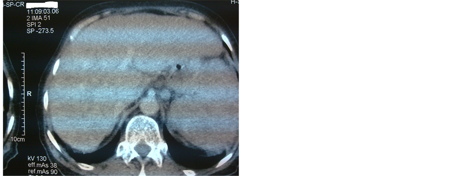 Hepato Splenic Tuberculosis in Acute Cholecystitis