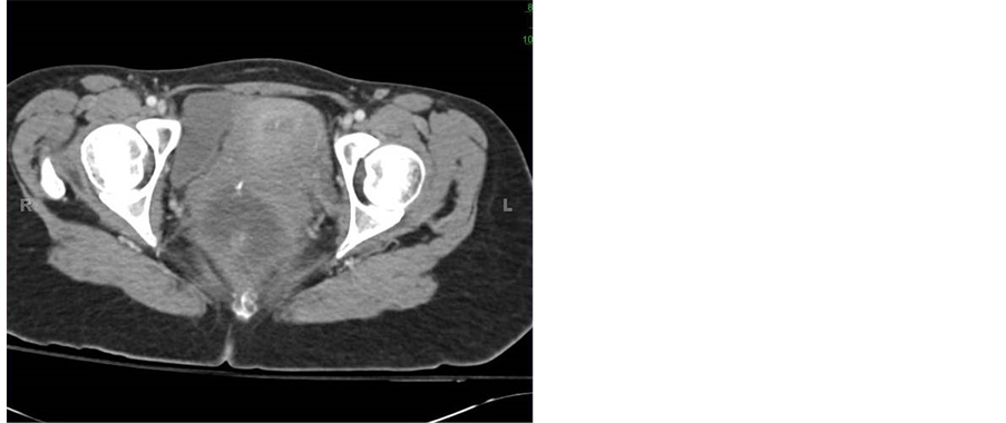 Long-axis rotational volvulus in an ileal J-pouch anal anastomosis: A ...