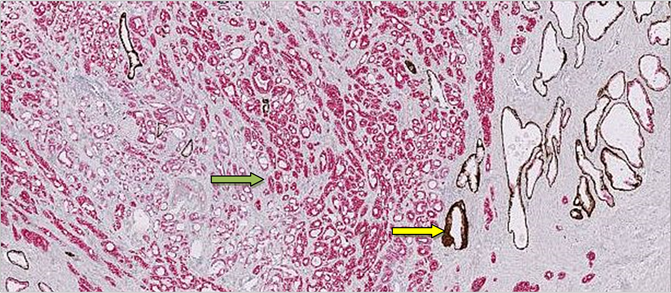 Automated Detection and Quantification of Prostate Cancer in Needle ...