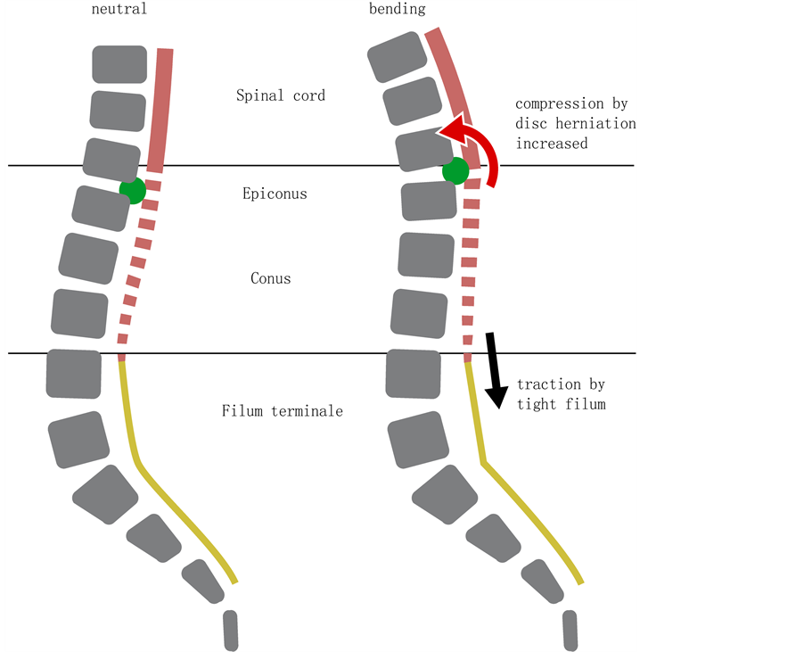 Thoraco-Lumbar Junction Disc Herniation and Tight Filum: A Unique ...