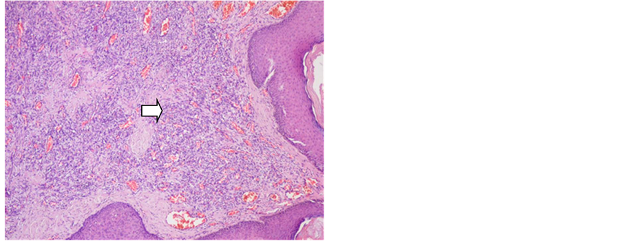 Pyogenic Granuloma of Nasal Septum: A Case Report and Review of Literature