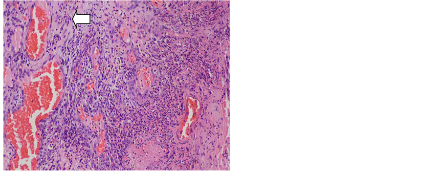 Pyogenic Granuloma of Nasal Septum: A Case Report and Review of Literature