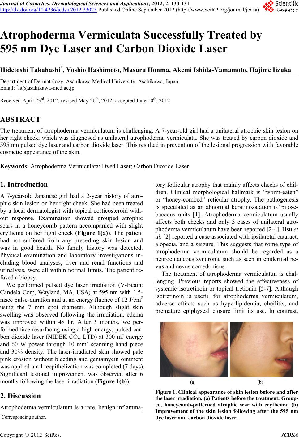 Atrophoderma Vermiculata Successfully Treated By 595 Nm Dye Laser And Atrophoderma Vermiculata Successfully Treated By 595 Nm Dye Laser And