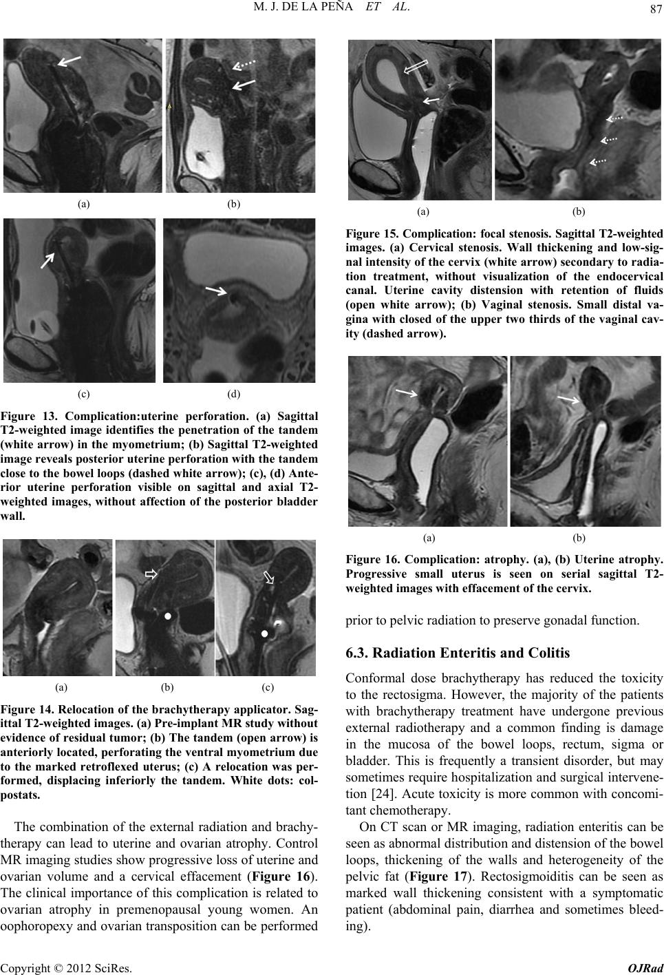 MRI-Brachytheraphy of Cervical Carcinoma—A Pictorial Review for the ...