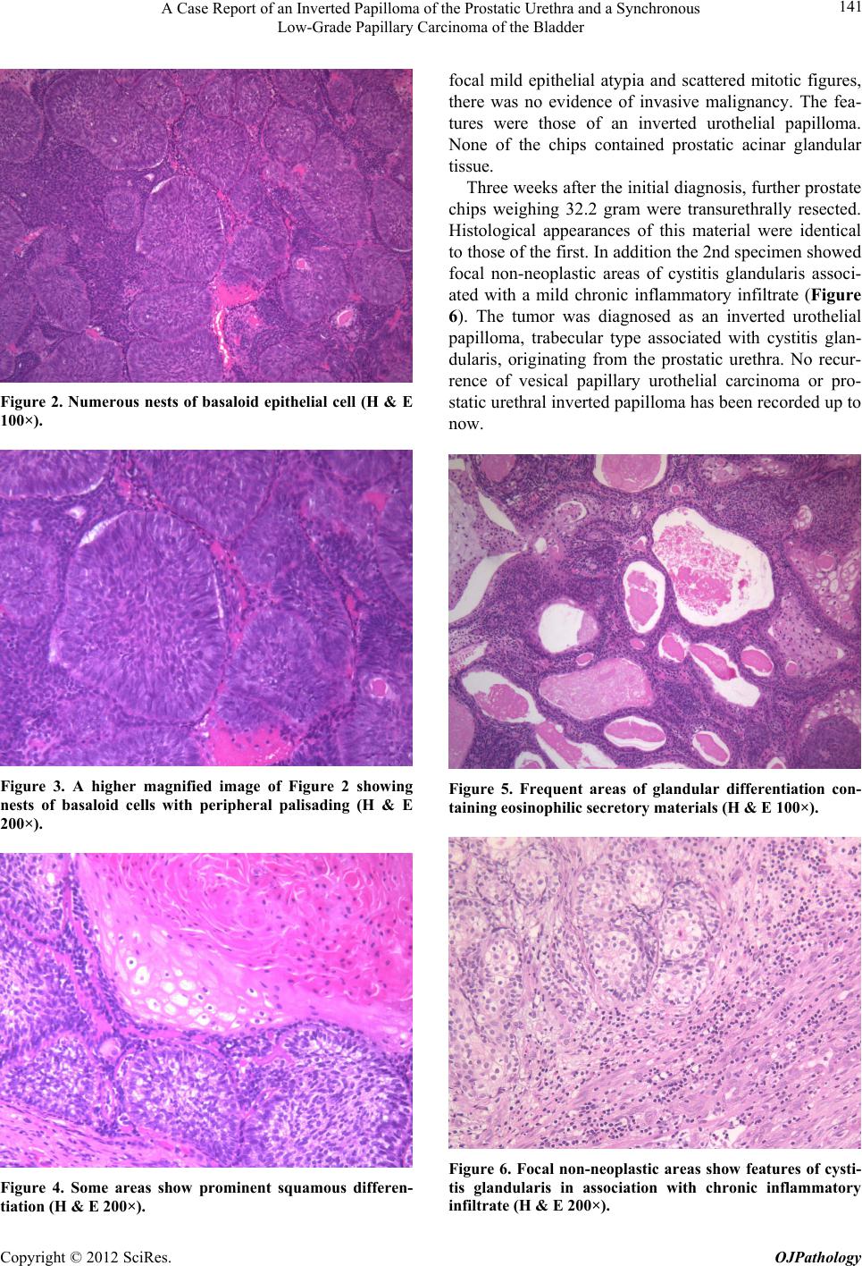 Inverted Papilloma Bladder