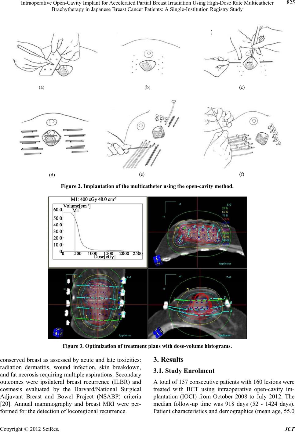 Intraoperative Open-Cavity Implant for Accelerated Partial Breast ...