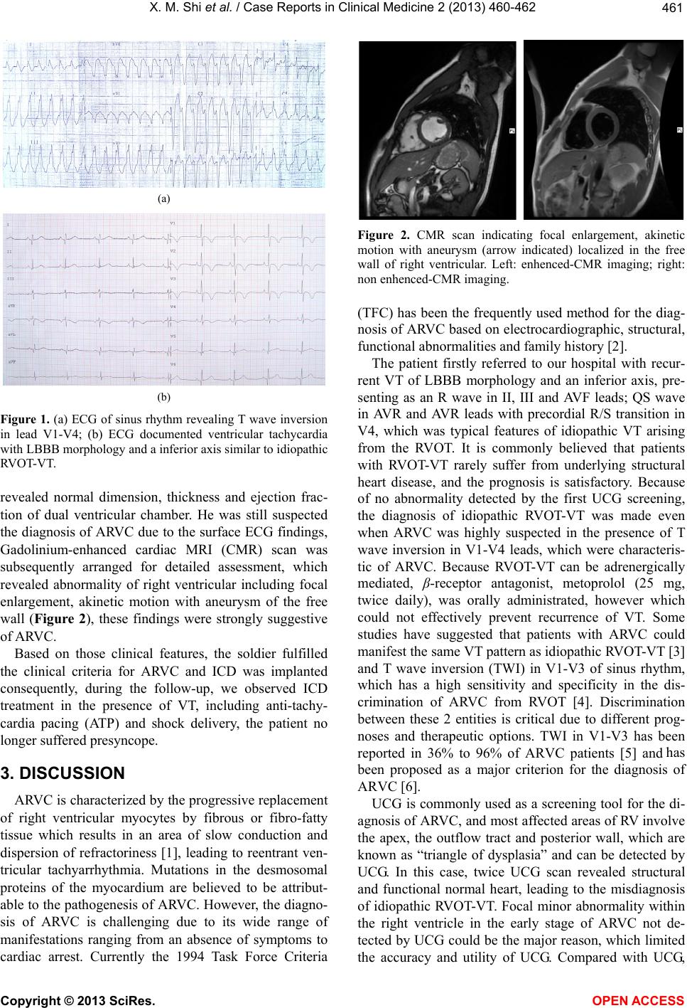 Arrhythmogenic right ventricular cardiomyopathy associated ventricular ...