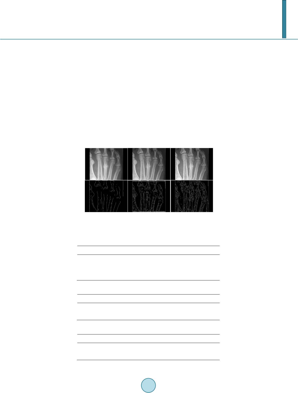Implementation of Shock Filter for Digital X-Ray Image Processing