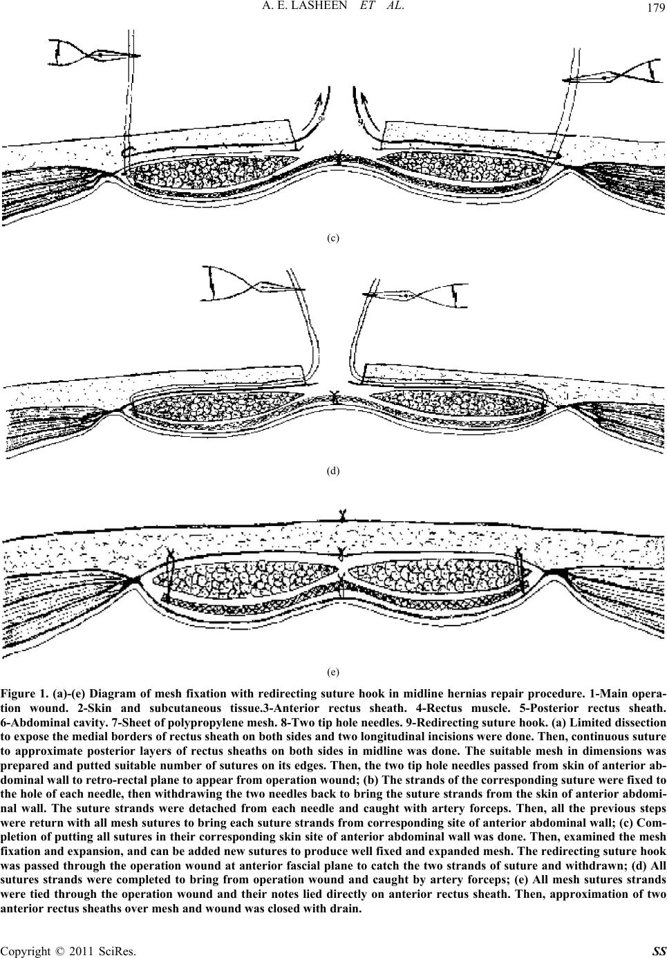 Percutaneous Mesh Expansion and Fixation at the Retro-Rectus Plane without Stabs by Using ...