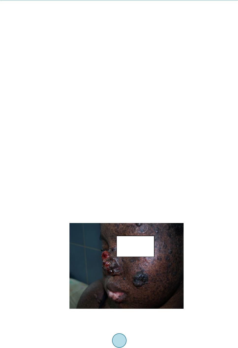 Malignant and Pre-Malignant Manifestations of Xeroderma Pigmentosum in ...
