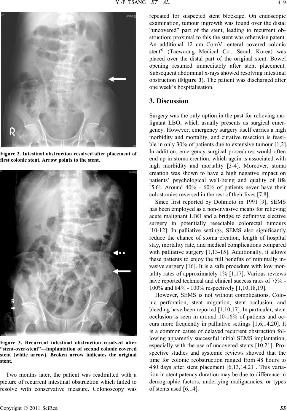 Management of Recurrent Large Bowel Obstruction Due to Stent Occlusion ...